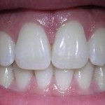 Does Running Damage Your Teeth? - The Runner's Resource