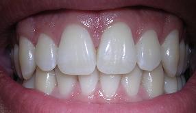 Does Running Damage Your Teeth? - The Runner's Resource