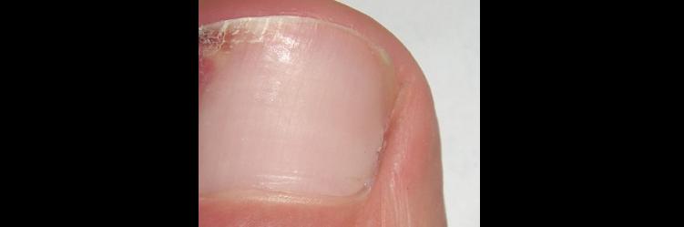 How to Treat an Ingrown Toenail - The Runner's Resource